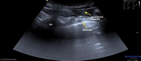 Frontiers Single Ultrasound Guided Thoracic Paravertebral Block With A Large Volume Of