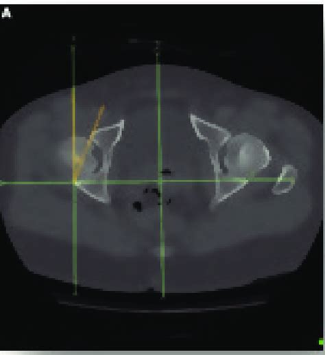 It Shows Acetabular Version Angle Measurement It Is Measured By Download Scientific Diagram