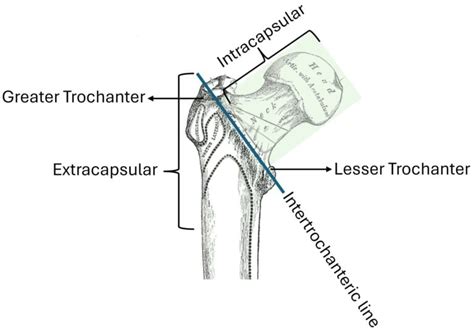 Neck Of Femur Nof Fractures Scrub Book