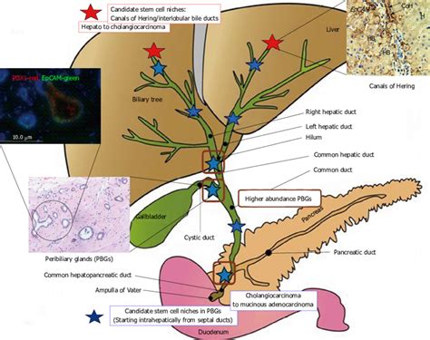 Cholangiocarcinoma Diagram