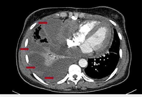 What Is Loculated Spill At Ernest Rue Blog