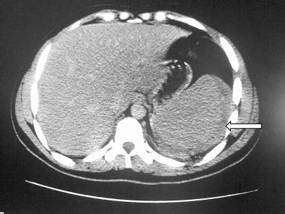 Esplenomegalia Concise Medical Knowledge