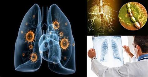 Как да разпознаем пневмония без кашлица За Жената