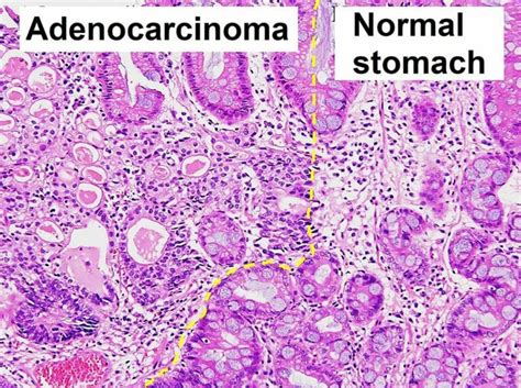 Gastric Cancer Concise Medical Knowledge
