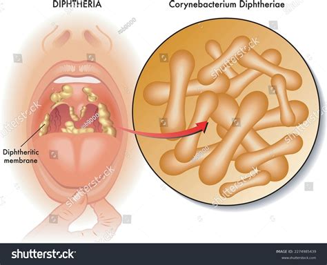 Diphtheria Over 625 Royalty Free Licensable Stock Vectors And Vector Art Shutterstock