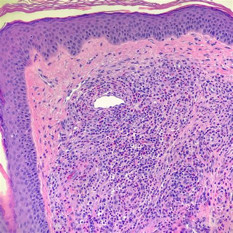 Granuloma Faciale Histology