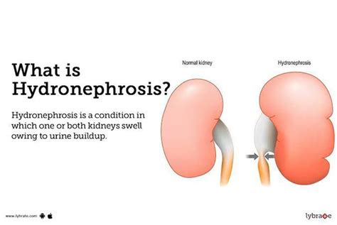 Hydronephrosis Medizzy