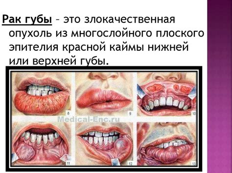 Рак нижний губы презентация онлайн