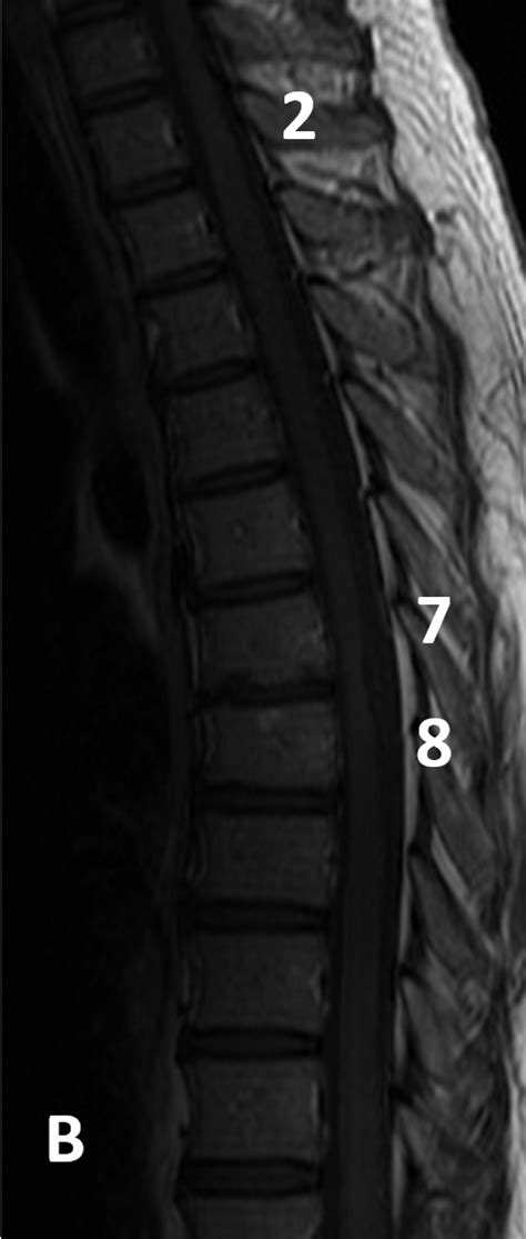 Cervical Spine Mri Ms