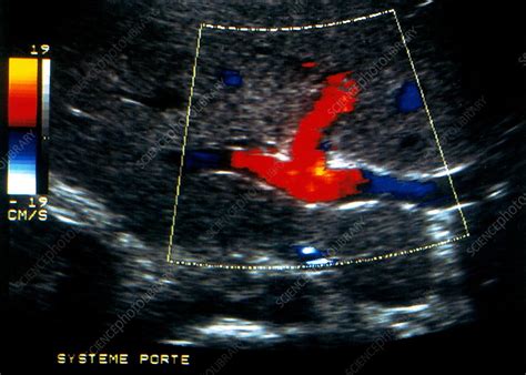 Portal Vein Ultrasound Scan Stock Image P2060287 Science Photo