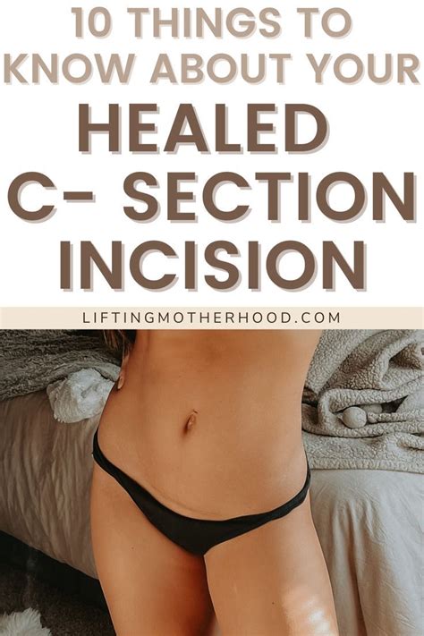 10 Things About Your Healed C Section Incision Artofit