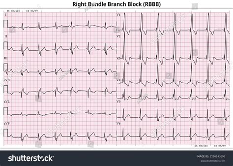 Ecg Rbbb Right Bundle Branch Block Stock Vector Royalty Free 2280143693 Shutterstock