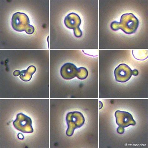 Urine Sediment Of The Month Dysmorphic Rbcs The Hallmark Of