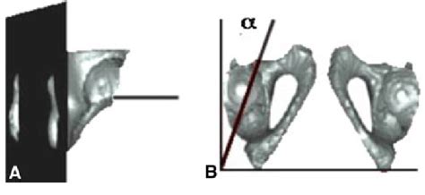 A B Diagrams Illustrate The Assessment Of The Acetabular Version Based Download Scientific