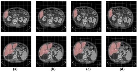 Illustration Of 3d Dataset Augmentation A Original Ct B Elastic