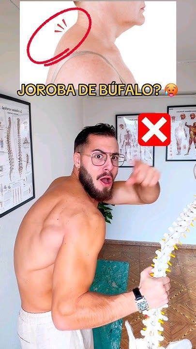 La Joroba De Búfalo Se Corrige Así