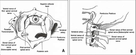 Ponticulus Posticus Dento Metric Radiología Dental Oral Y Maxilofacial