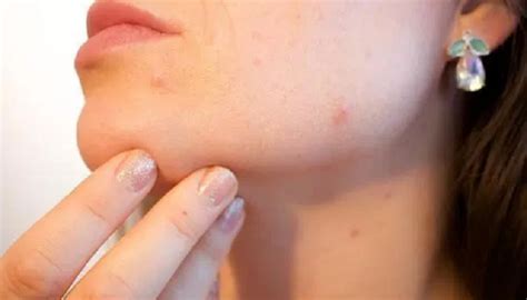 Pimples On Chin Meaning Myth And Its Location Guide For Your Skin