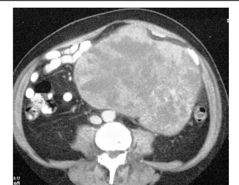 Figure 2 From The Radiology Of Gastrointestinal Stromal Tumours Gist