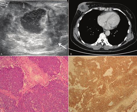 A Ultrasound Examination Showed A Mixed Cystic Solid Mass Type Iv