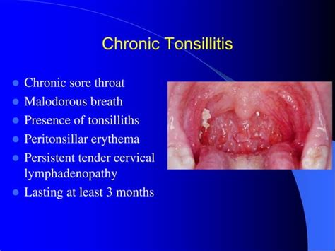 L6tonsillitis Adenoids Tonsillar Hypertrophy Lecturepdf