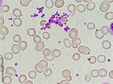 Essential Thrombocytosis Blood Smear Showing Abnormal High Volume Of