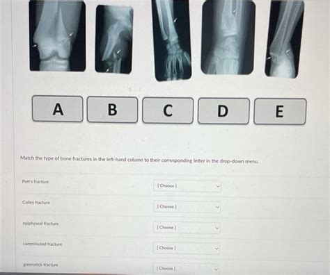 [solved] Match The Type Of Bone Fractures In The Left Hand