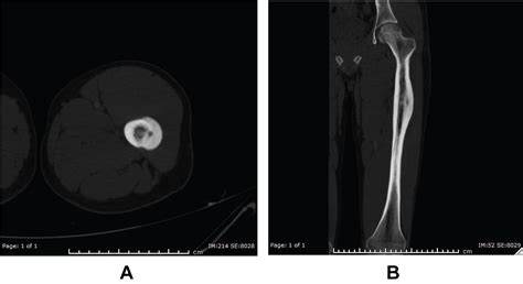 Evaluation Of The Patterns Of Benign Bone Tumors And Tumor Like Lesions
