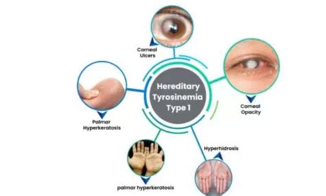 Tyrosinemia A Metabolic Disorder Affecting The Metabolism Of Amino