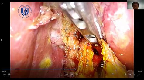 Laparoscopic Redo Hepaticojejunostomy——biliary Strictures After Laparoscopic Pancreaticoduodenec