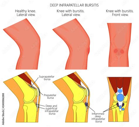 Vector Illustration Of A Healthy Knee And Unhealthy Knee With Deep