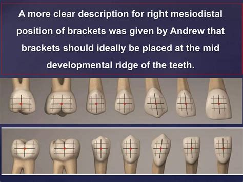 Bracket Placement Prof Maher Fouda Pptx