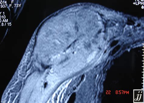 Msk Pathologic Fracture Of Humerus Proximal Humerus Tumor 1 Radioogle