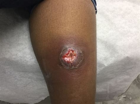 Paradoxical Reaction To Tnf α Inhibitor Therapy In A Patient With Hidradenitis Suppurativa Mdedge