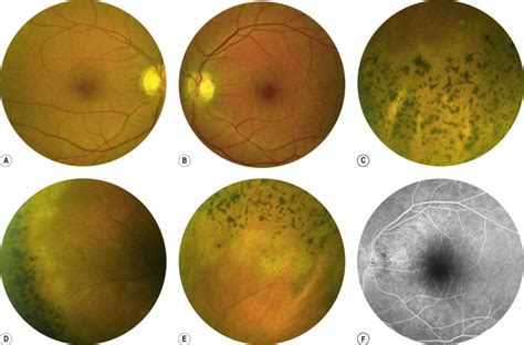 Rpe Mottling Macula