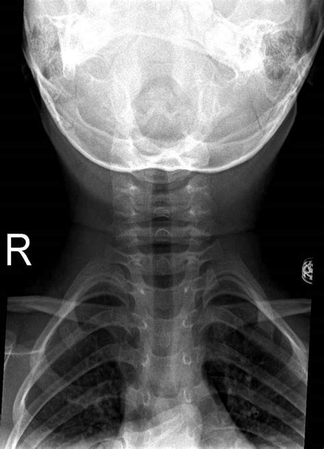 Healthy Cervical Spine Xray
