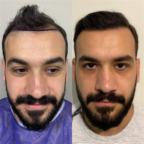 Hair Transplant Cost Artofit