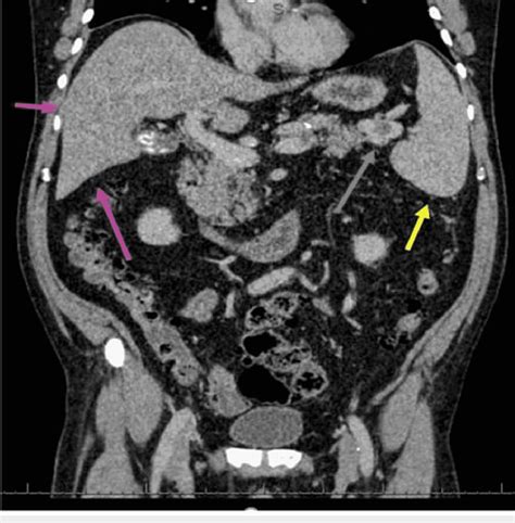 Computed Tomography Sagittal View With The Irregular Contour Of The Download Scientific