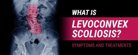 What Is Levoconvex Scoliosis Symptoms And Treatments