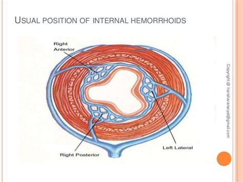 Piles Fistula Management Via Kshar Sutra Method