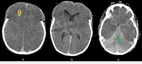 Head Computed Tomography Imaging Revealing Pronounced Global Download Scientific Diagram