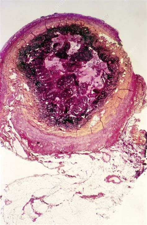 Appendicitis Light Micrograph Stock Image C0212841 Science