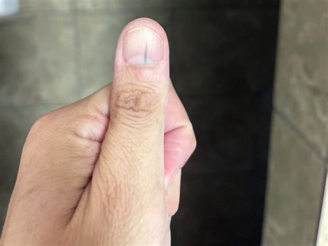 Woman Shares 1 Symptom That Revealed She Had Rare Skin Cancer In Her Nail