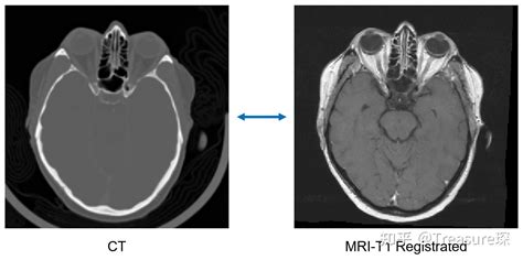 Python科研图像处理——ants多模态配准 知乎
