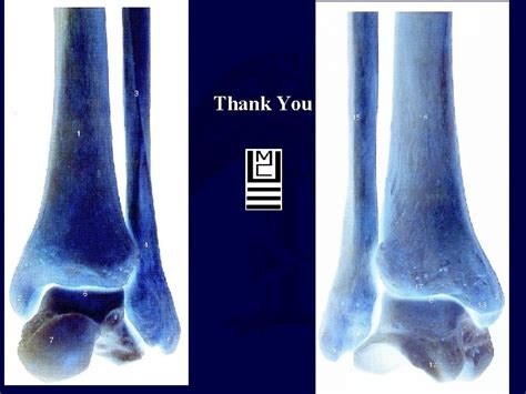 Ankle Fracture Update Ota Resident Core Curriculum Lecture