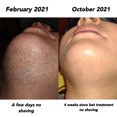 Hypertrichosi Hair Removal
