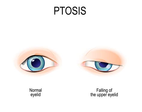 Eyelid Muscles Weak