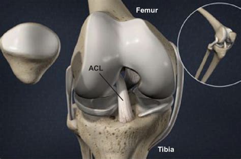 Understanding Acl Injuries And The Path To Recovery Optim Health System