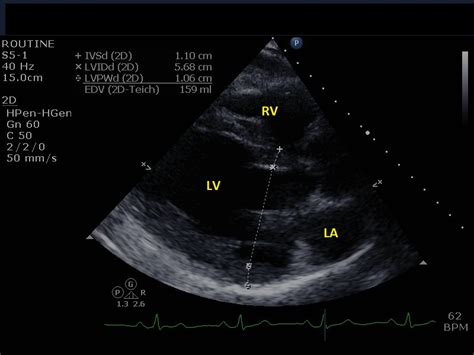 Volumetric Assessment Is More Precise Than Diameter For Determining Left Ventricular Size