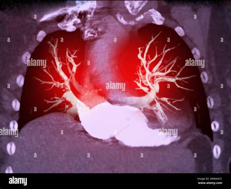 Cta Chest Or Ctpa With Contrast Media 3d Rendering For Diagnostic Pulmonary Embolism Pe Stock